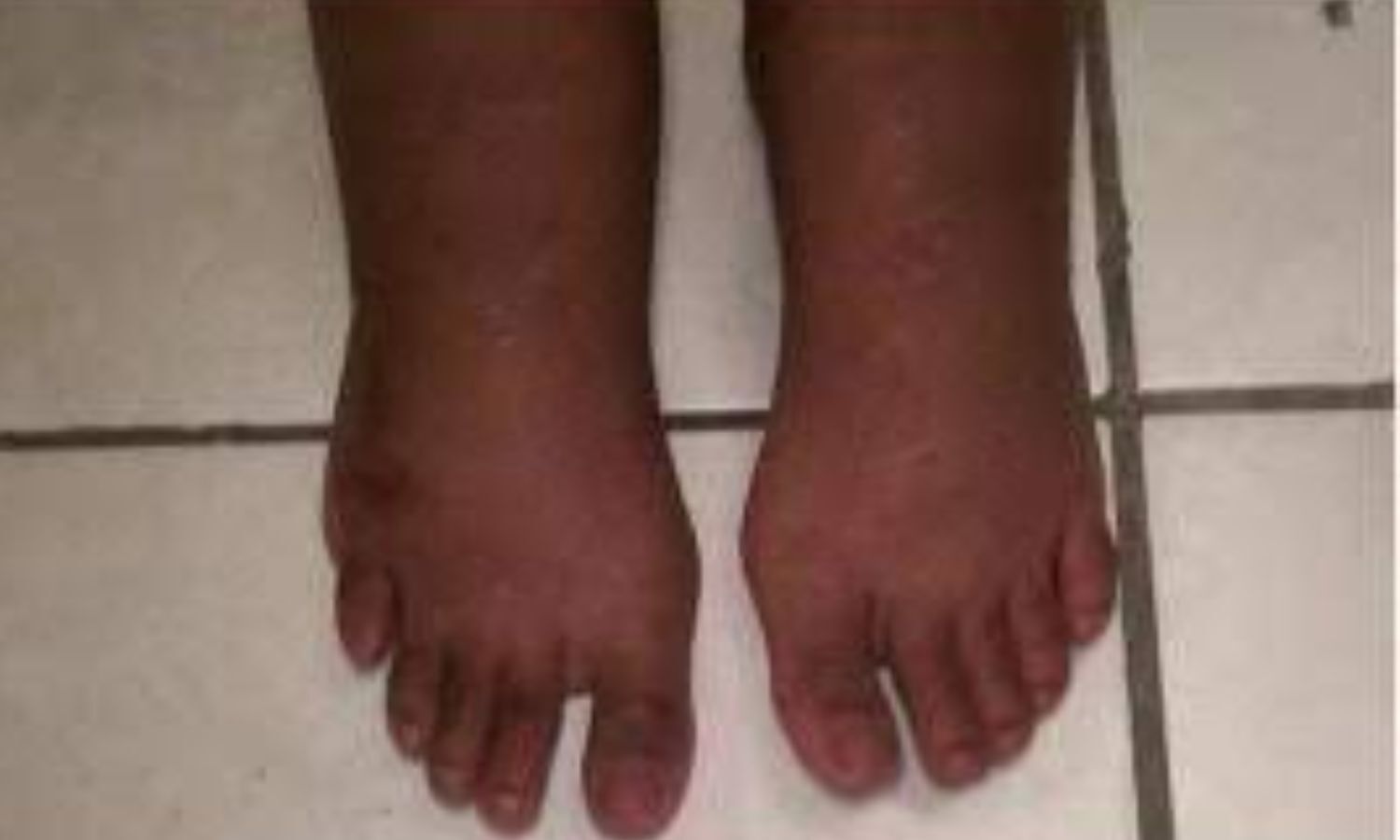 Rare case of developing pleural, pericardial effusion and anasarca with ...