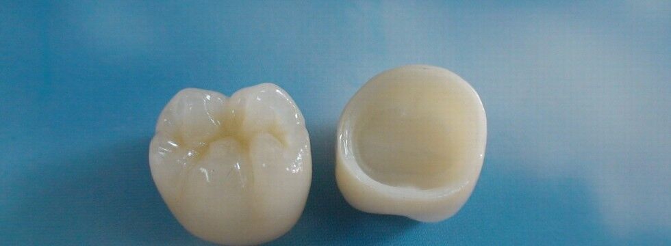 Adapting Occlusal design and adjustment may improve properties of ...