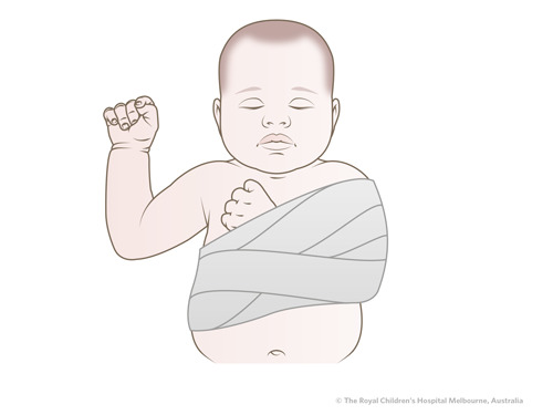 Caesarean delivery brings risk of fractures & birth palsy for newborn ...