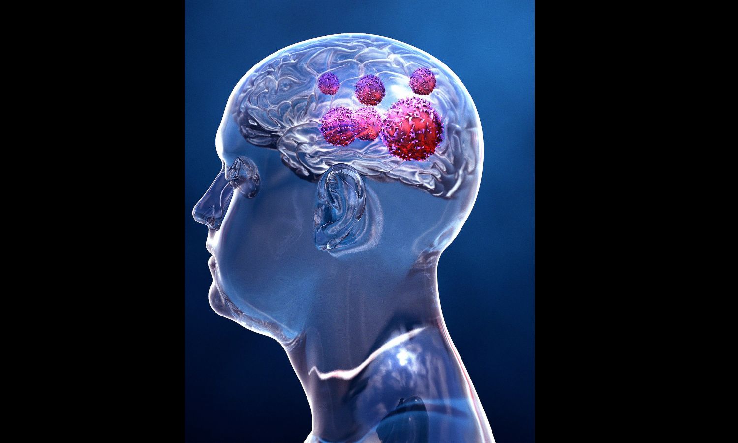 Elon Musk's Neuralink implant that will convert brains into the organic ...