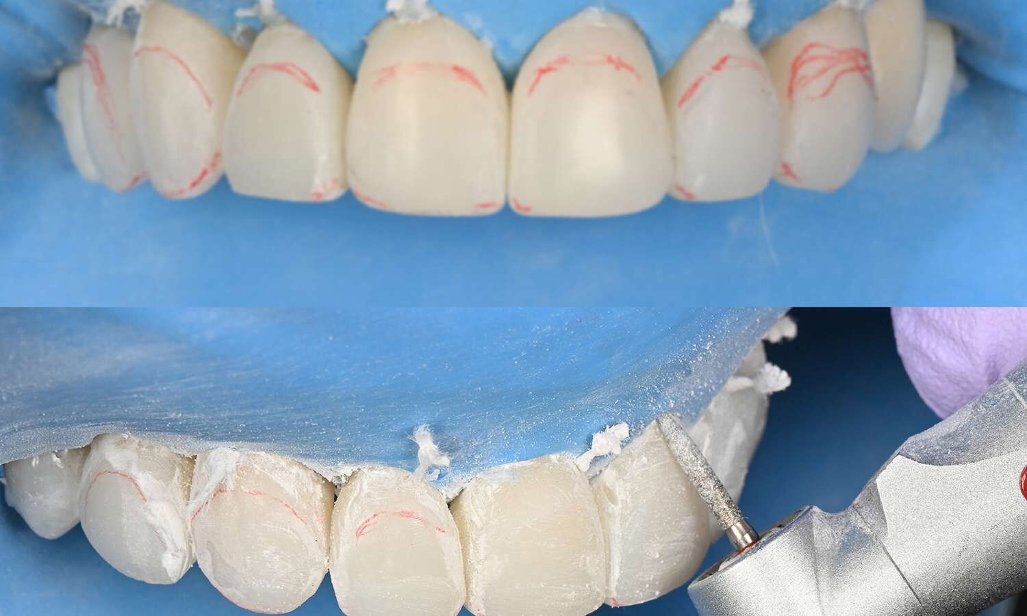 Composite resin teeth have a greater wear resistance than acrylic and ...