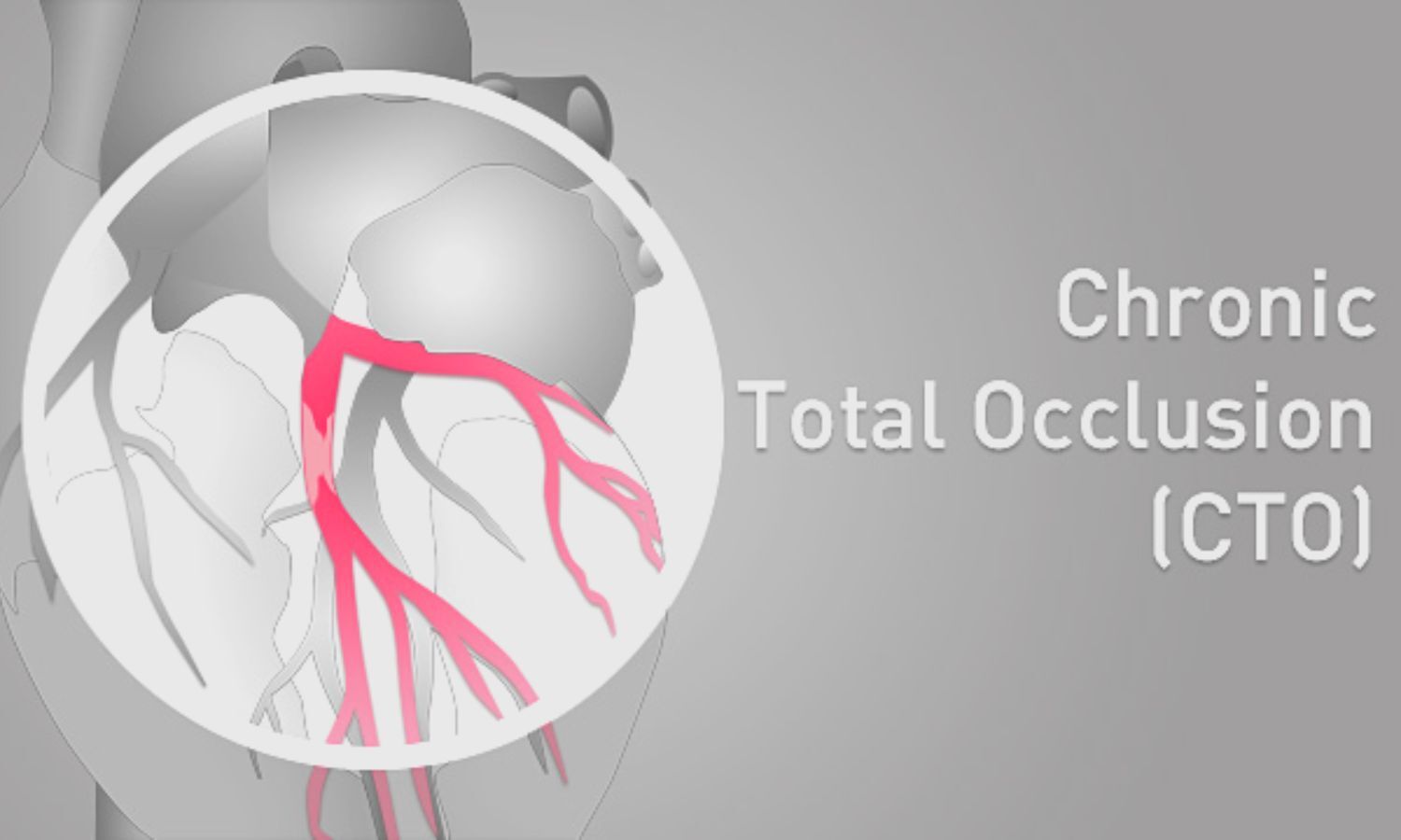 Successful CTO-PCI improves quality of life, outcomes in chronic total ...