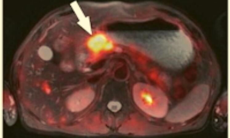 Bursectomy not a recommended standard procedure for cT3-T4a gastric cancer