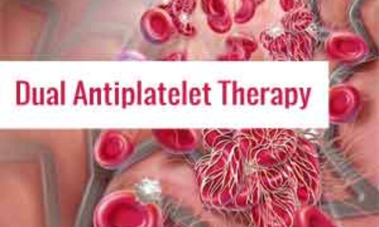 DAPT de-escalation strategy suitable for stabilized MI patients with ...