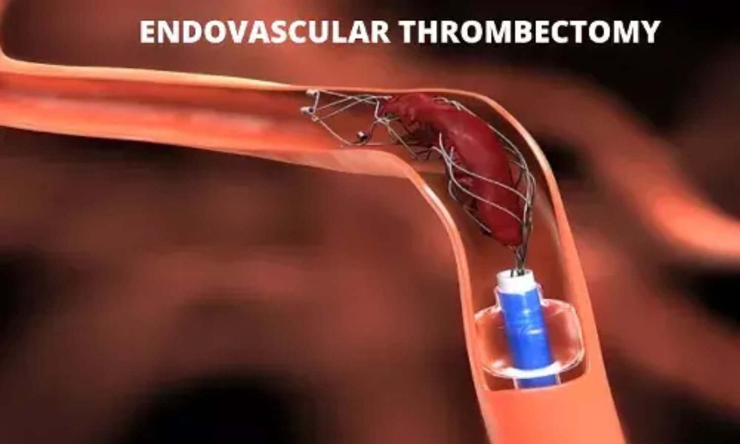 Endovascular Thrombectomy Exhibits Durable Benefit of Endovascular ...
