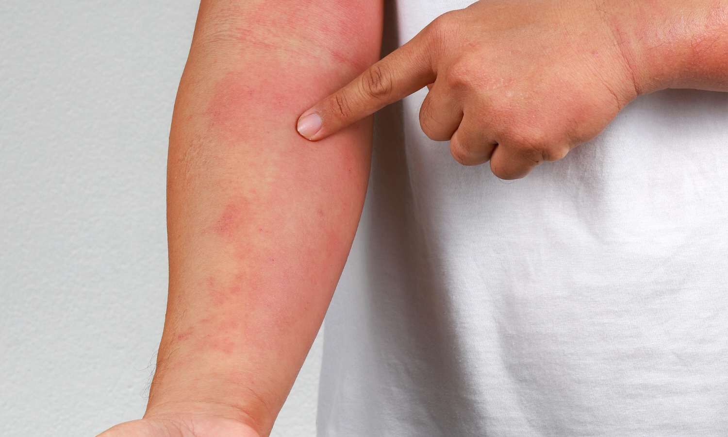 Baricitinib effective in cutaneous manifestations of dermatomyositis