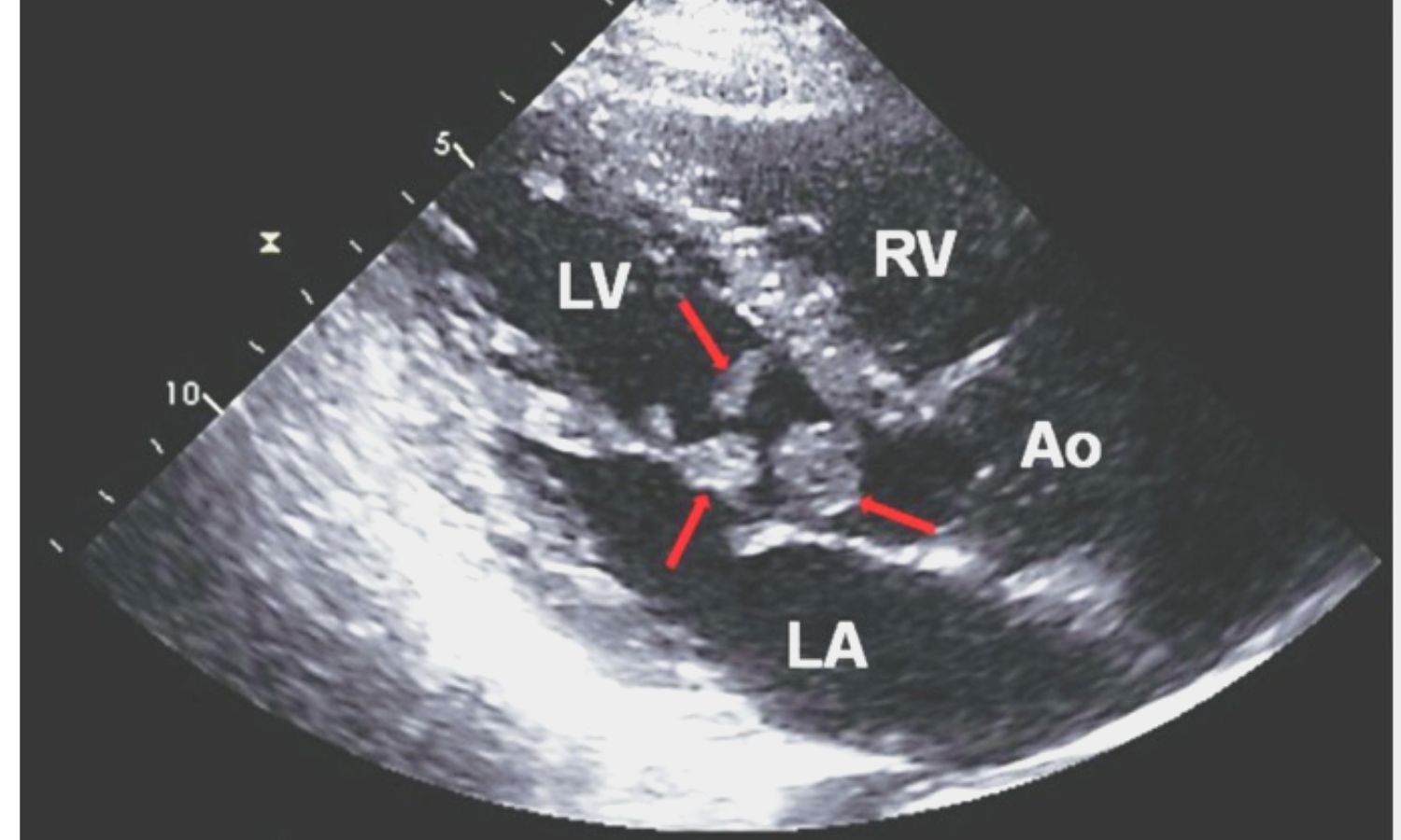 Echocardiographic features of cardiac masses can accurately diagnose ...