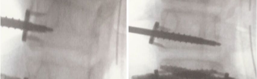 Use of electronic conductivity devices effectively reduces radiation ...