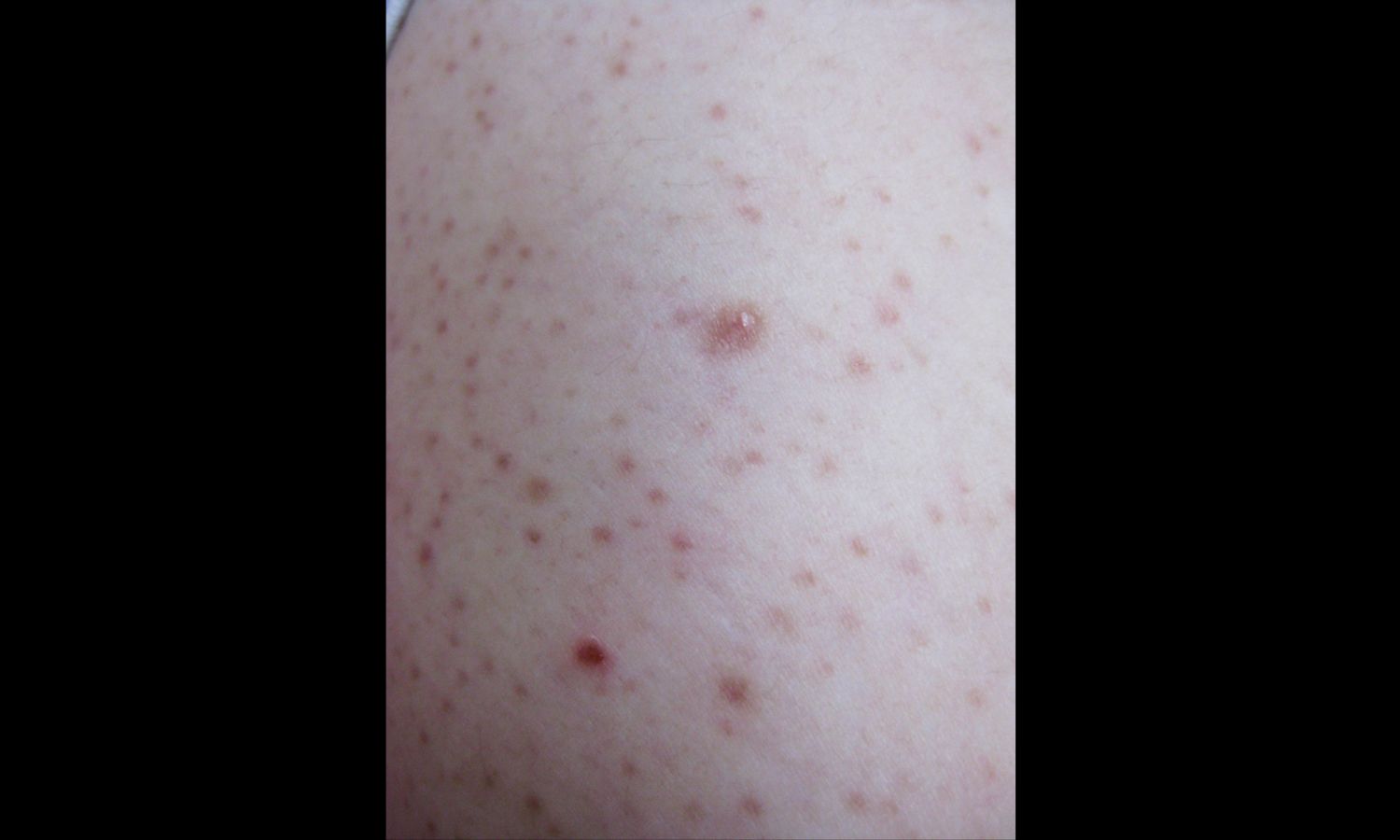 Have you got chicken skin? It’s actually Keratosis Pilaris