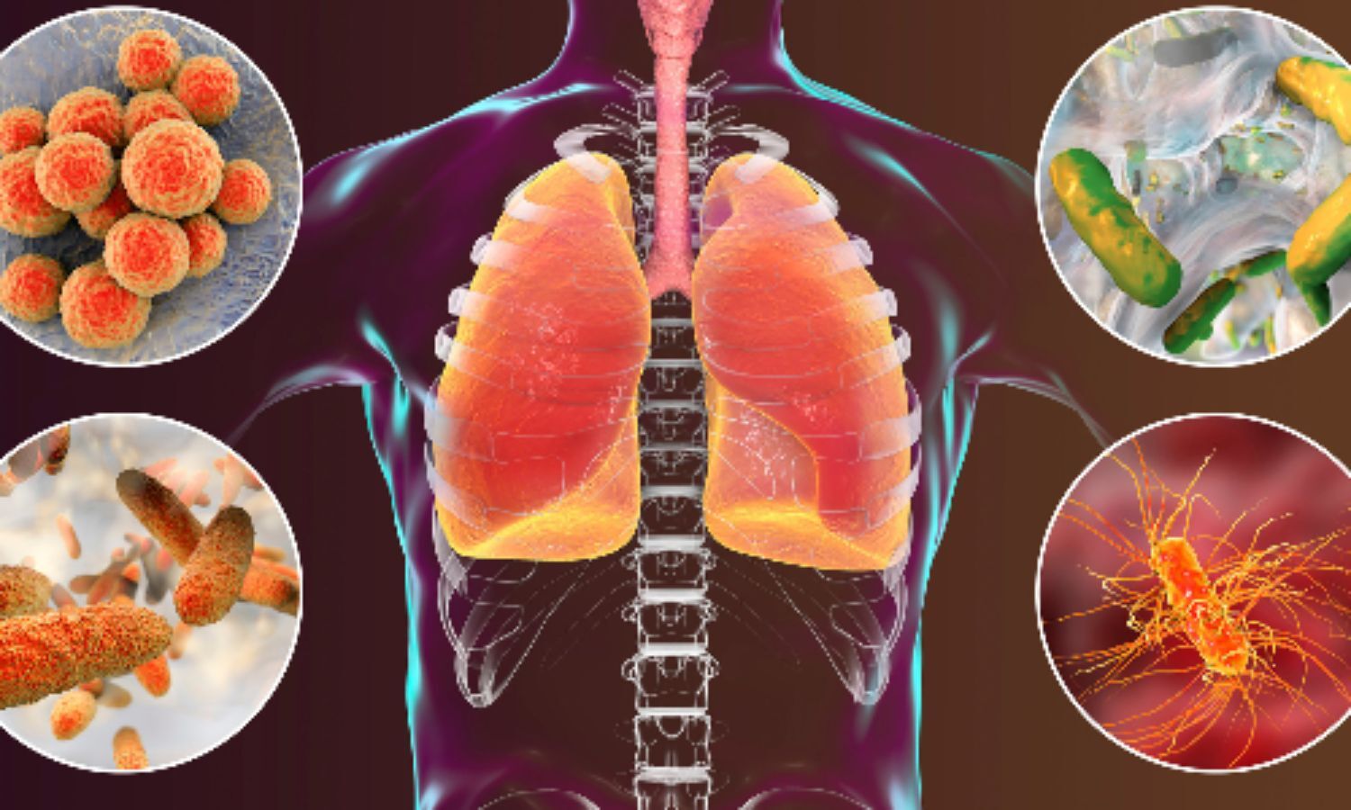 Colistin nebulization improves clinical outcomes in ICU-admitted ...