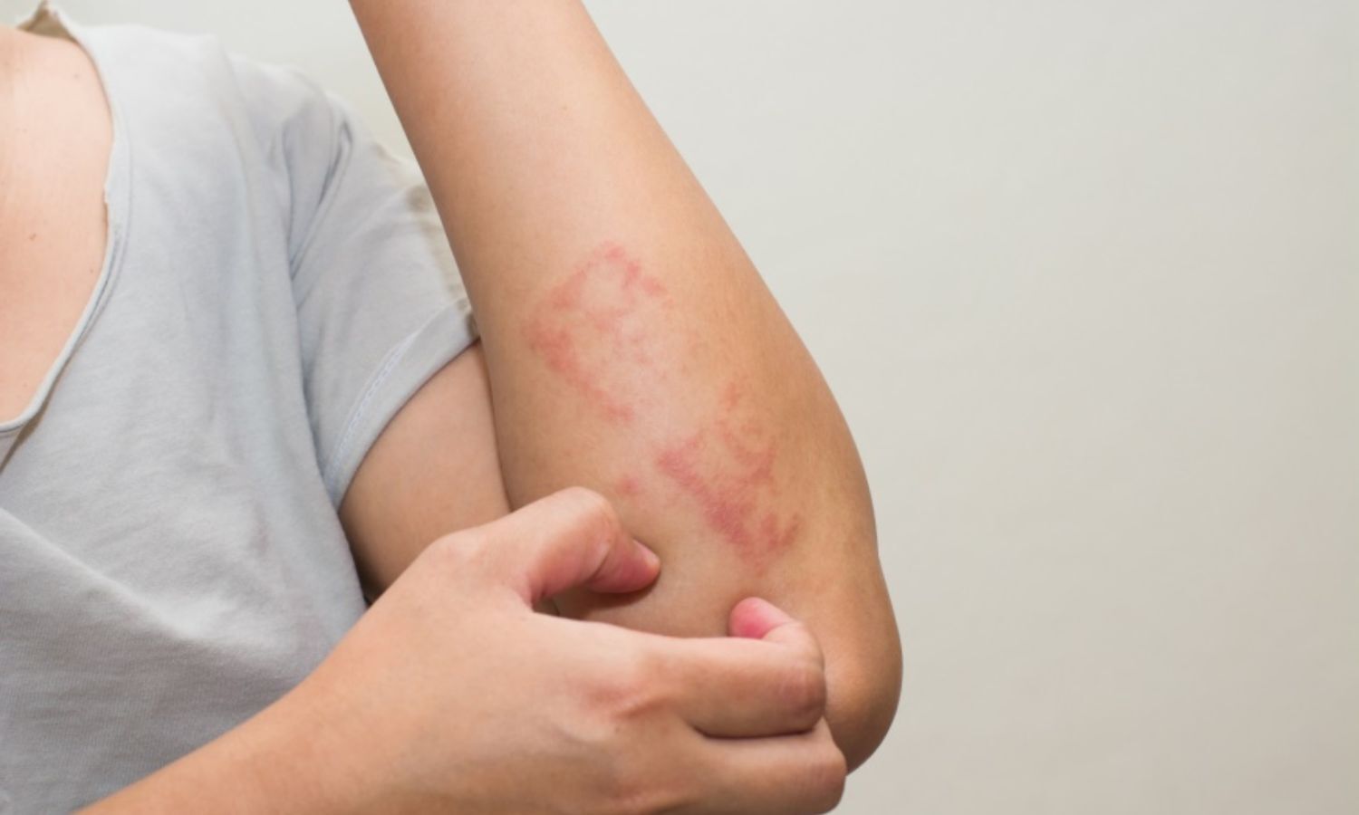 Isothiazolinone allergy in Europe on decline but rising in USA due to ...