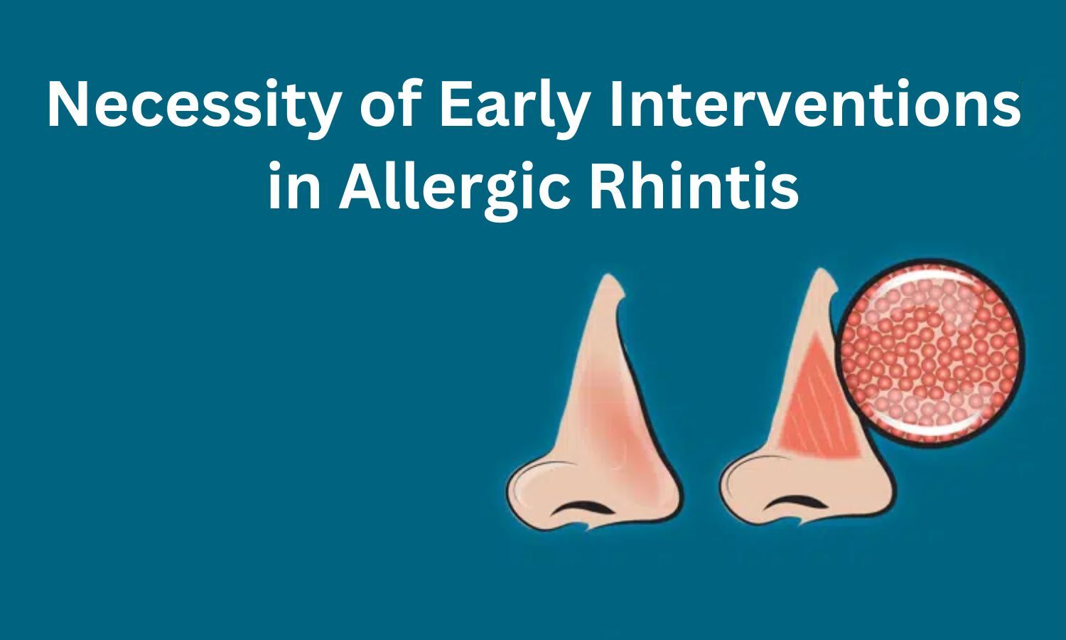 Decoding Complications of Allergic Rhinitis and Role of Early Interventions