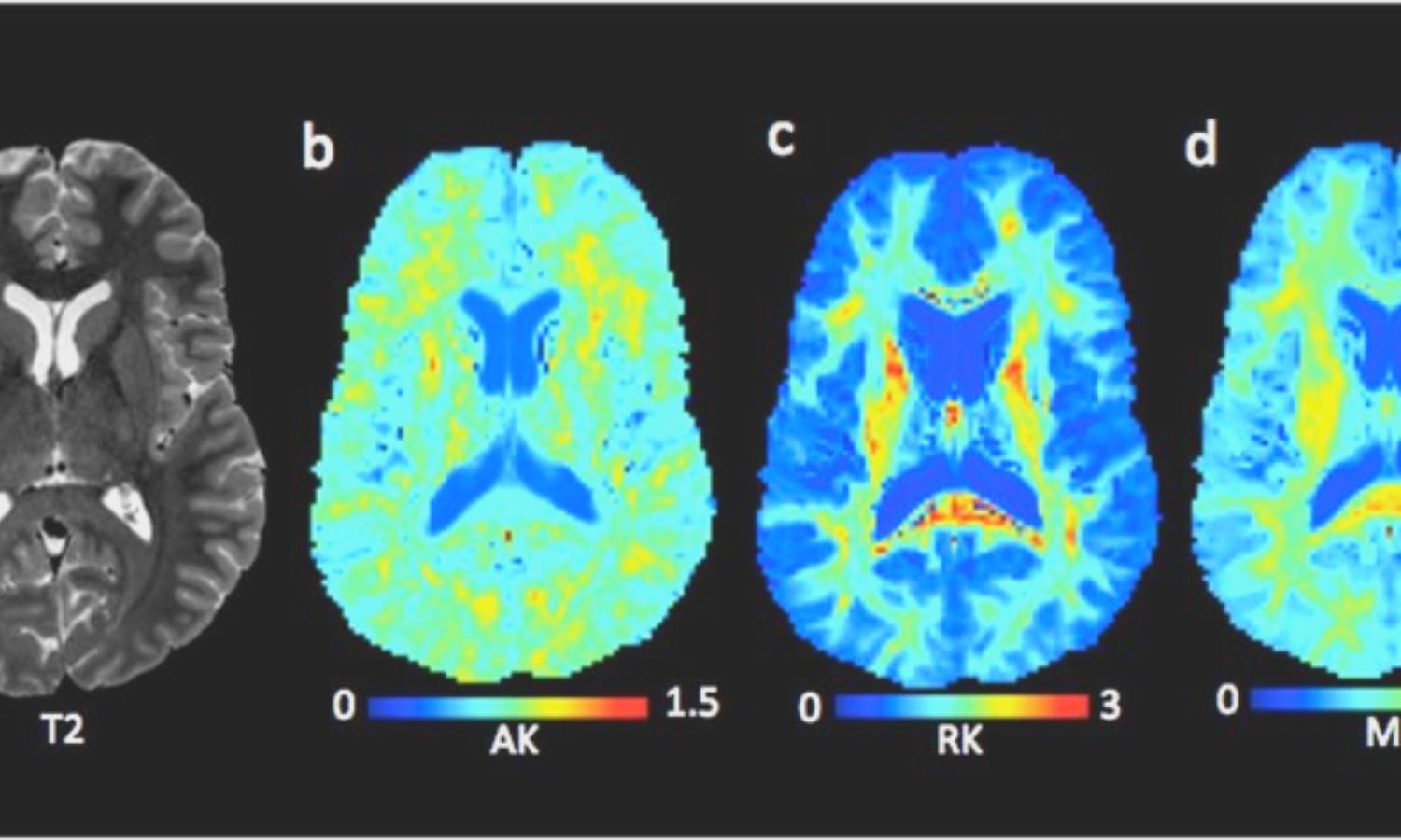 Diffusion kurtosis imaging can identify cognitive impairment in ...