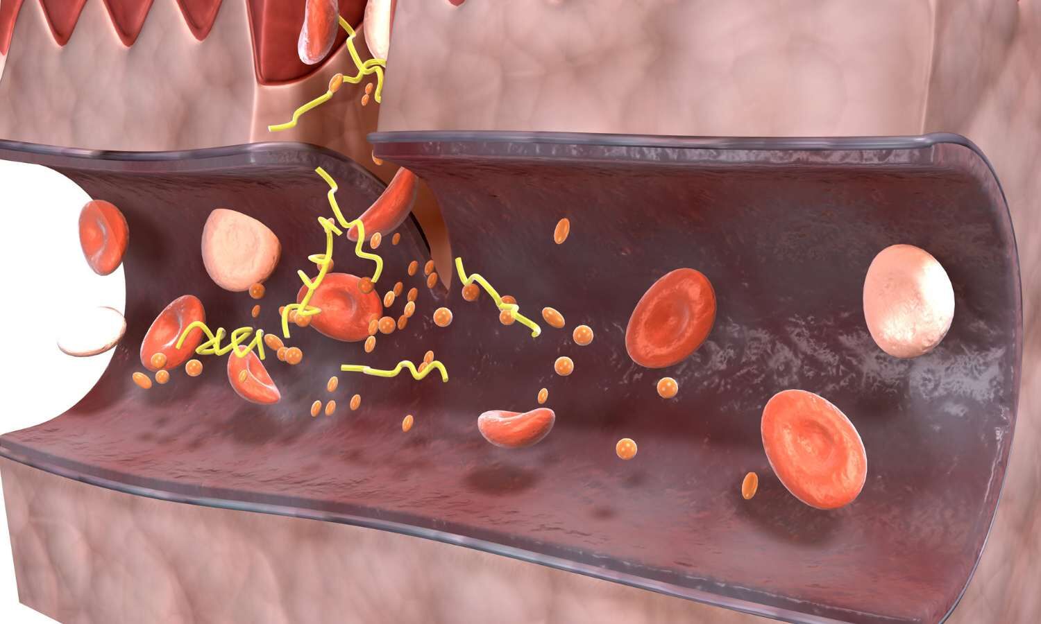 New technique uses vortex ultrasound to break down blood clots in ...