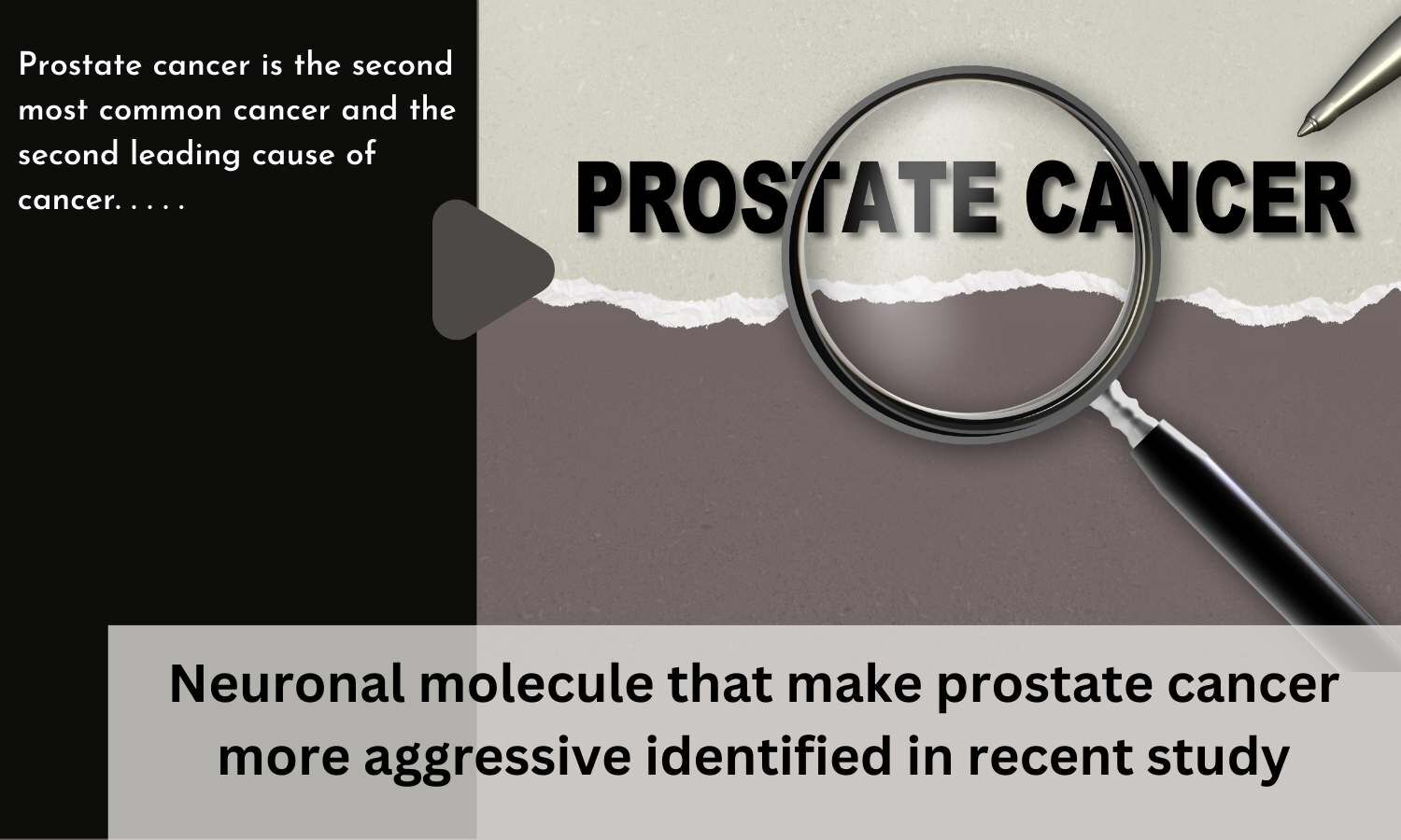 Neuronal molecule that make prostate cancer more aggressive identified ...