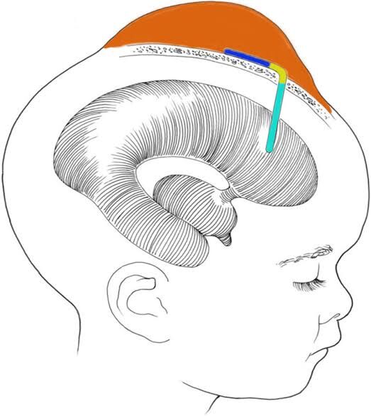 Ventriculosubgaleal shunt-Proposed technique for post-infectious ...