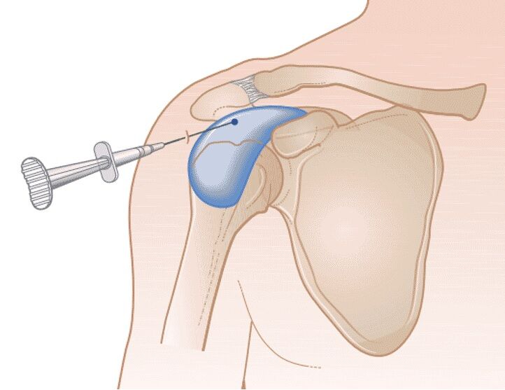 Lyophilized growth factors injection significantly reduces pain in ...