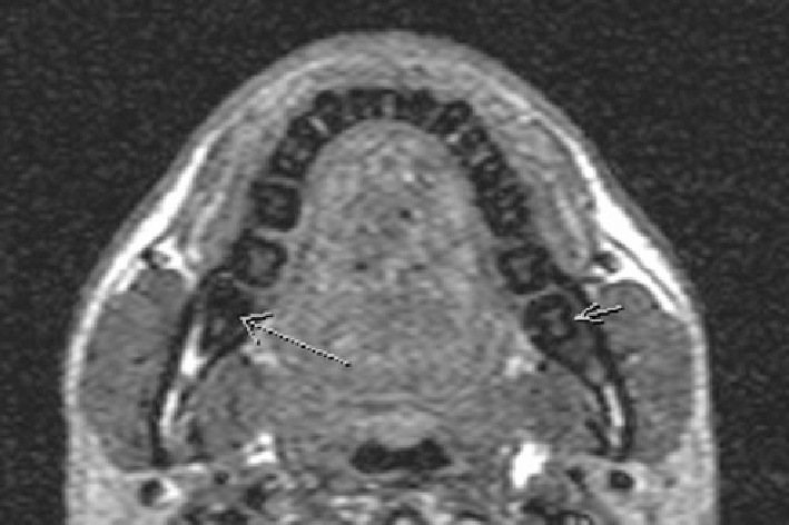 Magnetic resonance imaging benefits preoperative diagnosis in third ...