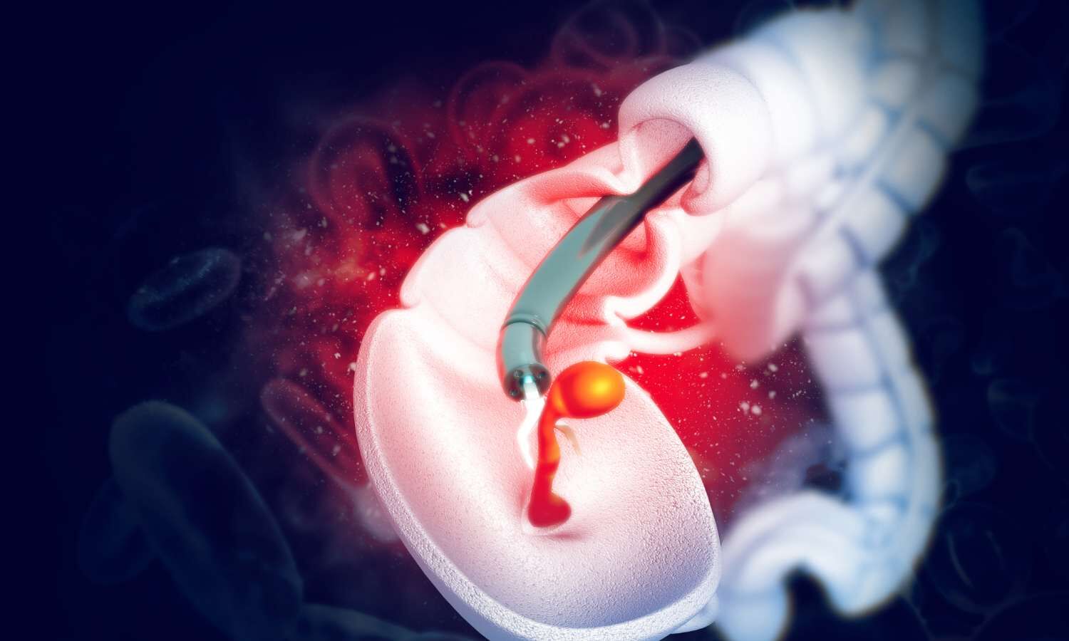 CT colonography not recommended for colorectal cancer screening: ACP ...