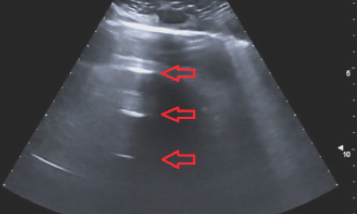 Lung ultrasound score can predict COVID-19 pneumonia severity, study ...