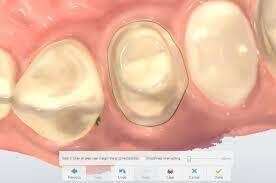 Intraoral scanners detect occlusal caries as accurately as clinical ...