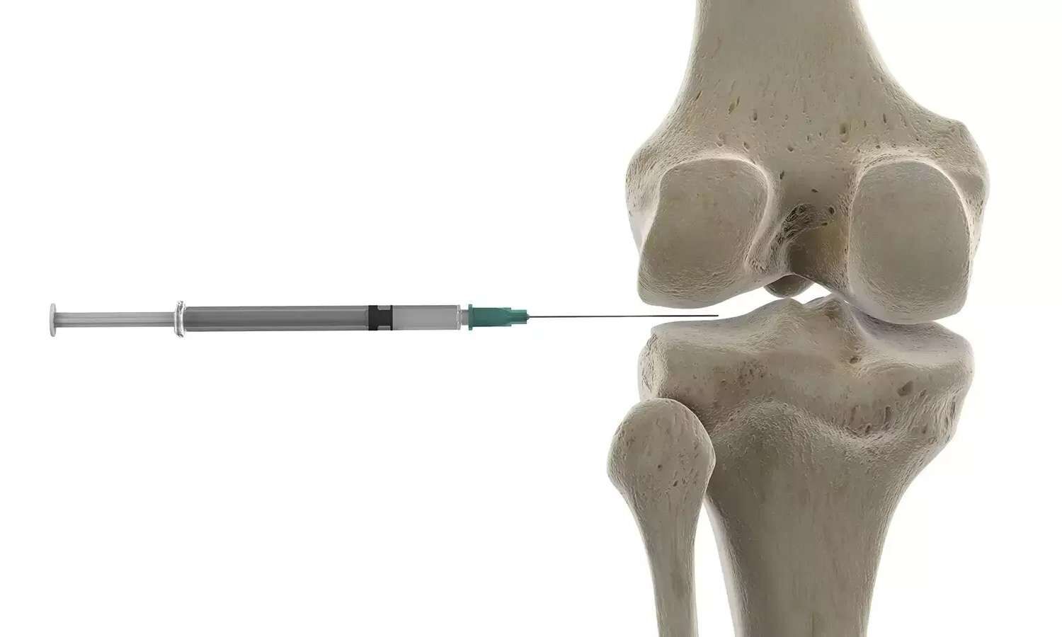 10 mg of triamcinolone acetonide non-inferior to 40 mg triamcinolone ...