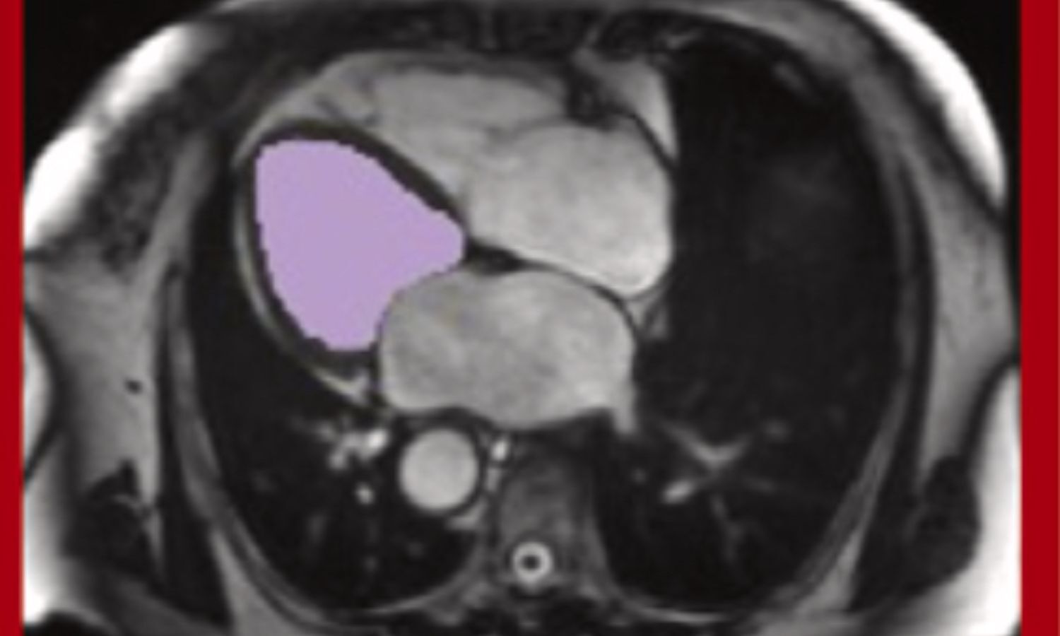 Spherical hearts identified through AI analysis of cardiac MRI may ...
