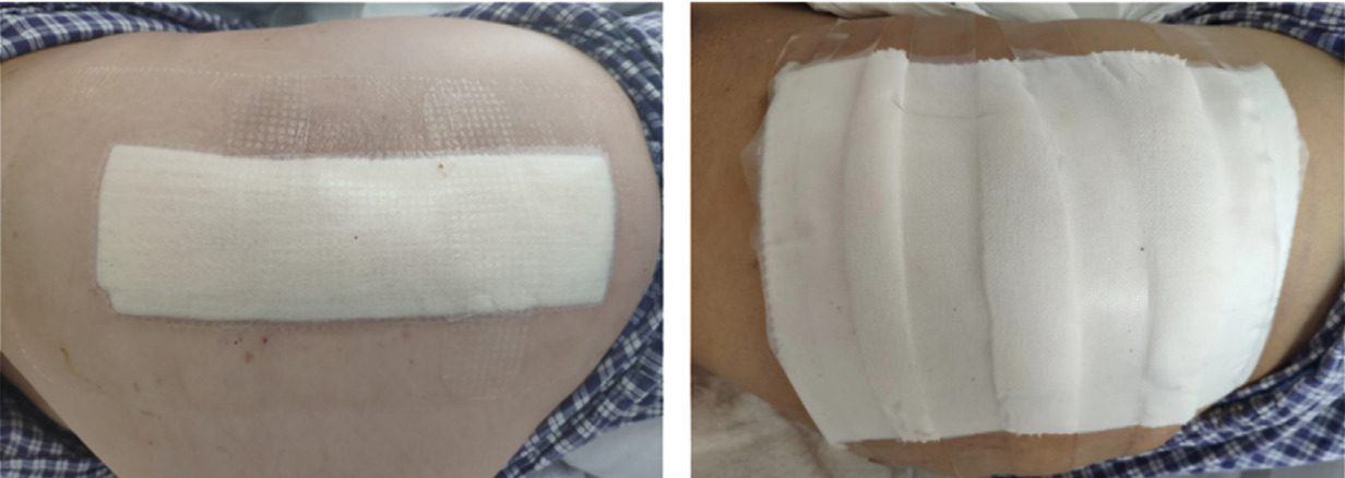 New dressing system could reduce number of dressings in enhanced ...