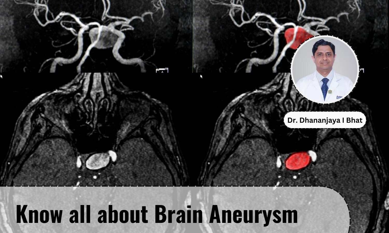 Brain Aneurysm: Symptoms, Risk Factors, And Treatment - Dr Dhananjaya I ...