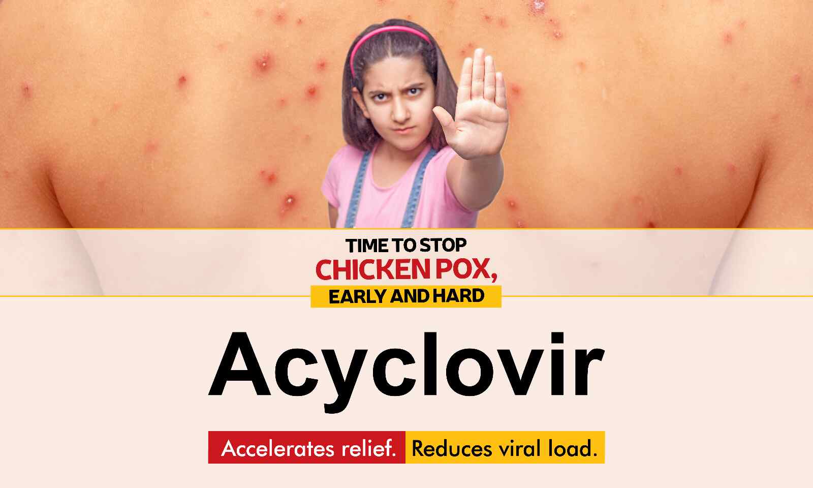 Prevention Of Chickenpox