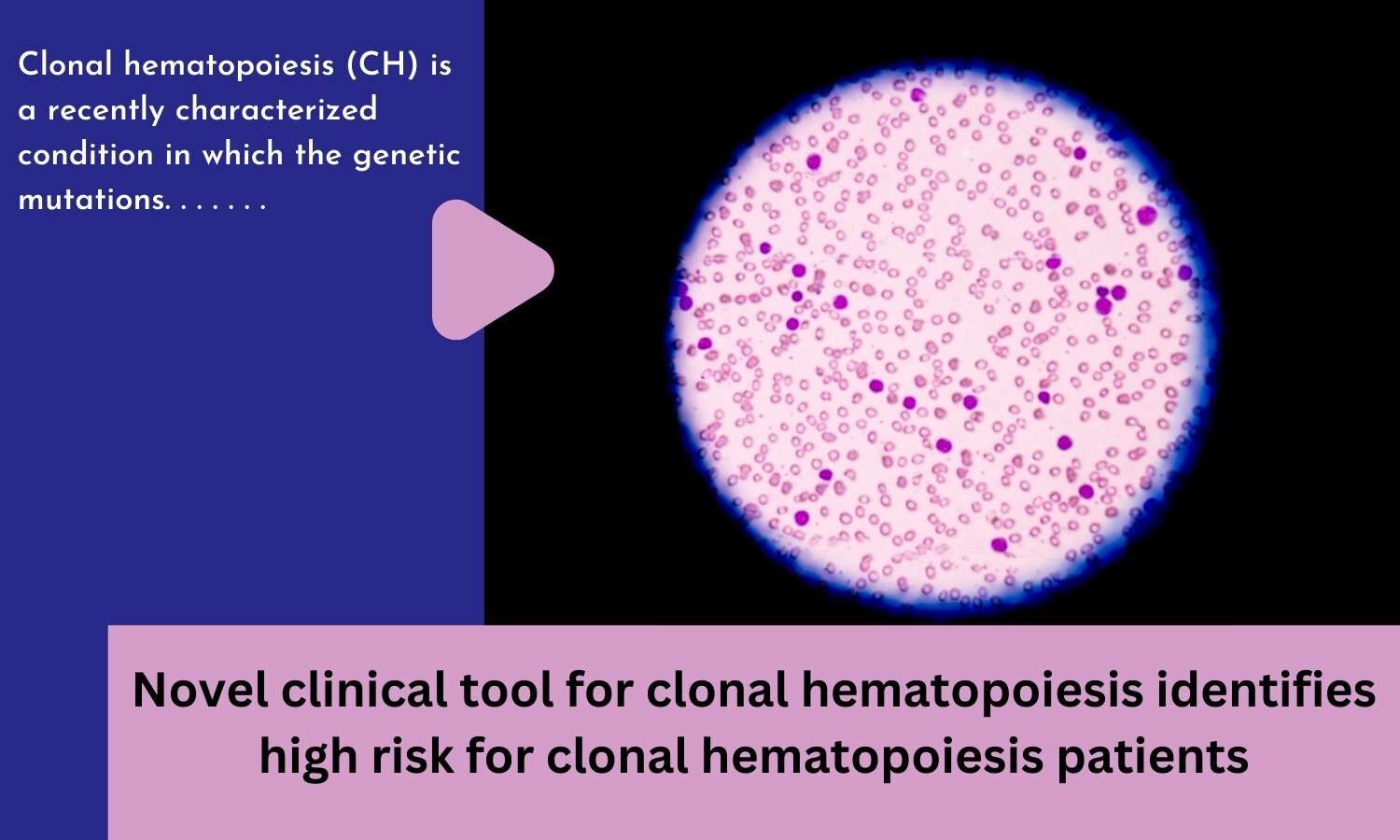 Novel Clinical Tool For Clonal Hematopoiesis Identifies High Risk For Clonal Hematopoiesis Patients