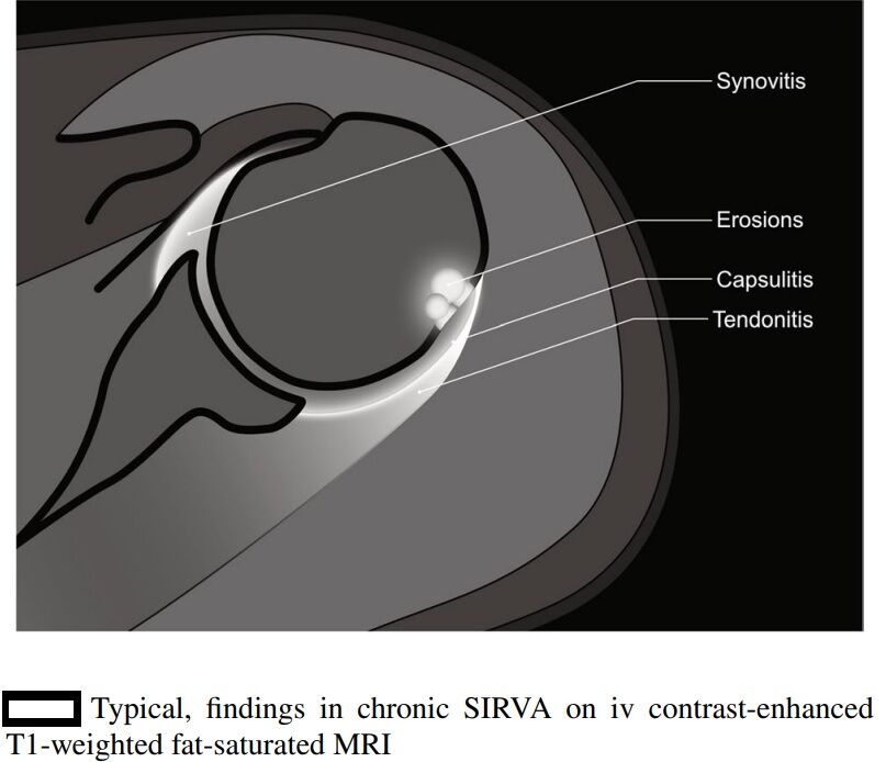 Greater humeral tuberosity erosions commonest MRI finding in chronic ...