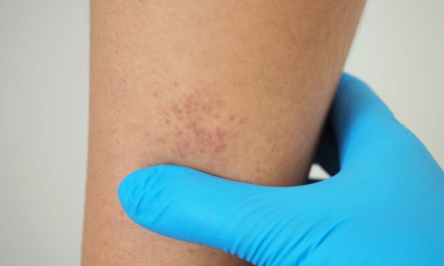 Thrombocytopenia Rash