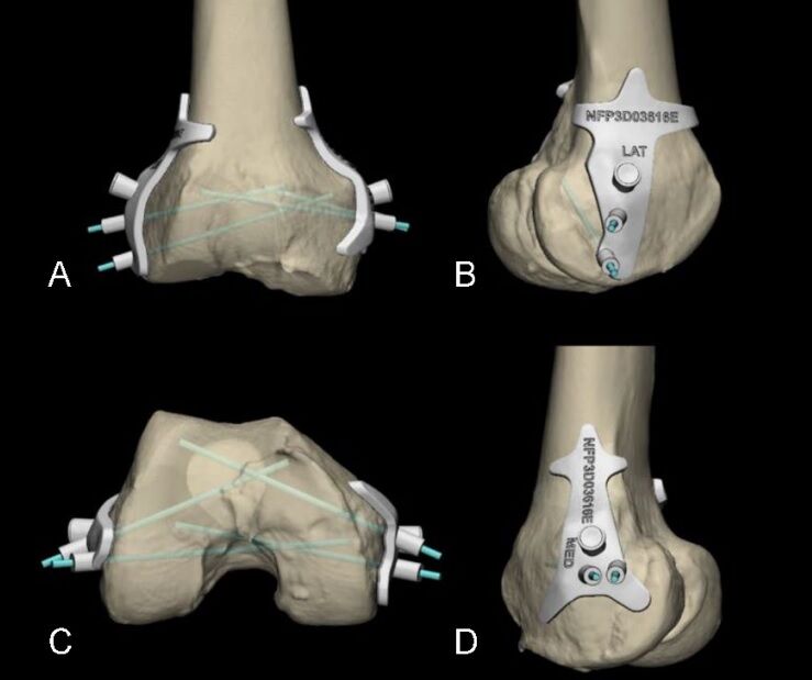 3D printed patient specific instrumentation accurate tool to reproduce ...