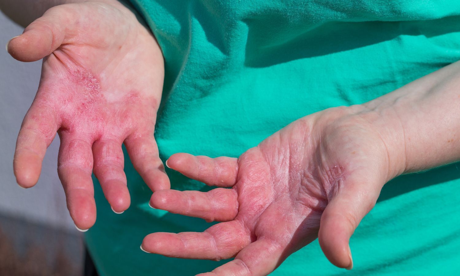 Mindfulness and Self-Compassion Training Improves Quality of Life for ...