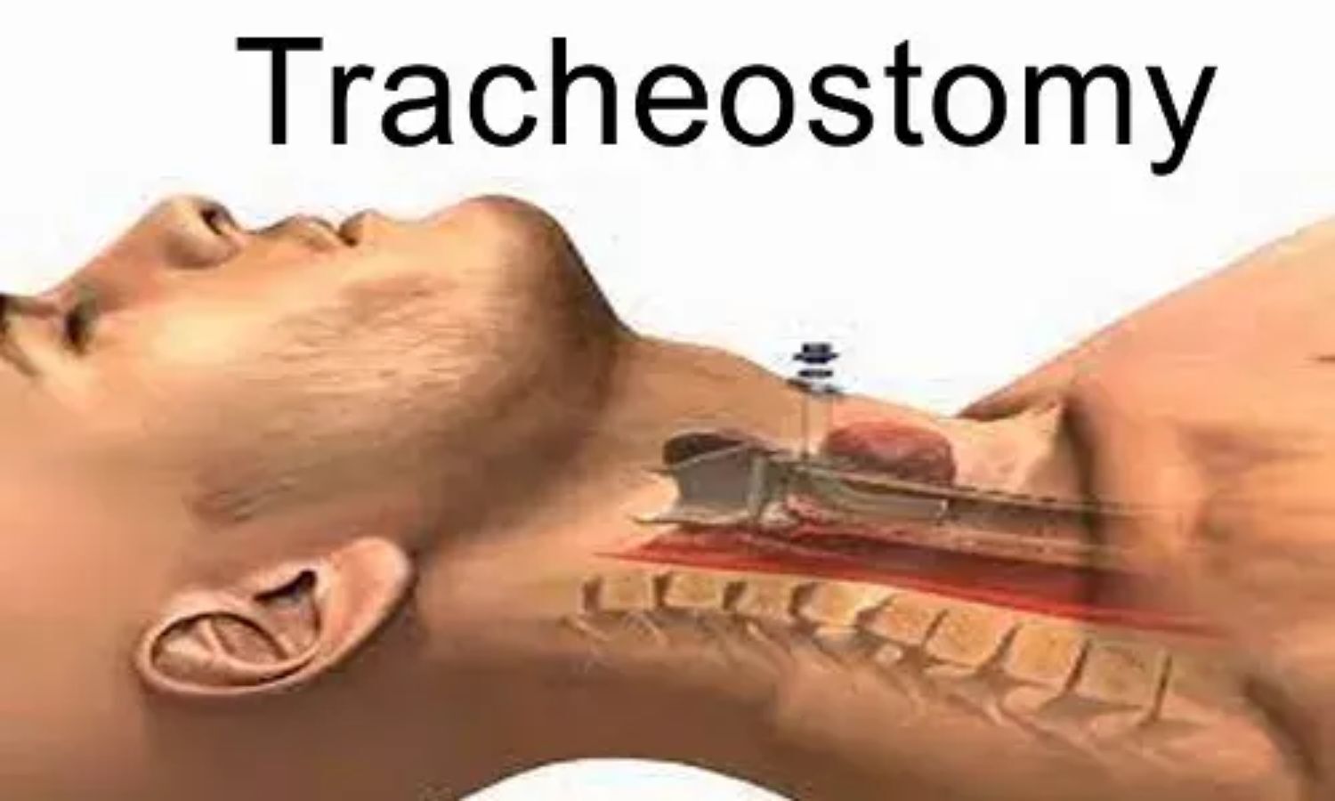 Tracheostomy timing does not affect outcomes in critically ill patients ...
