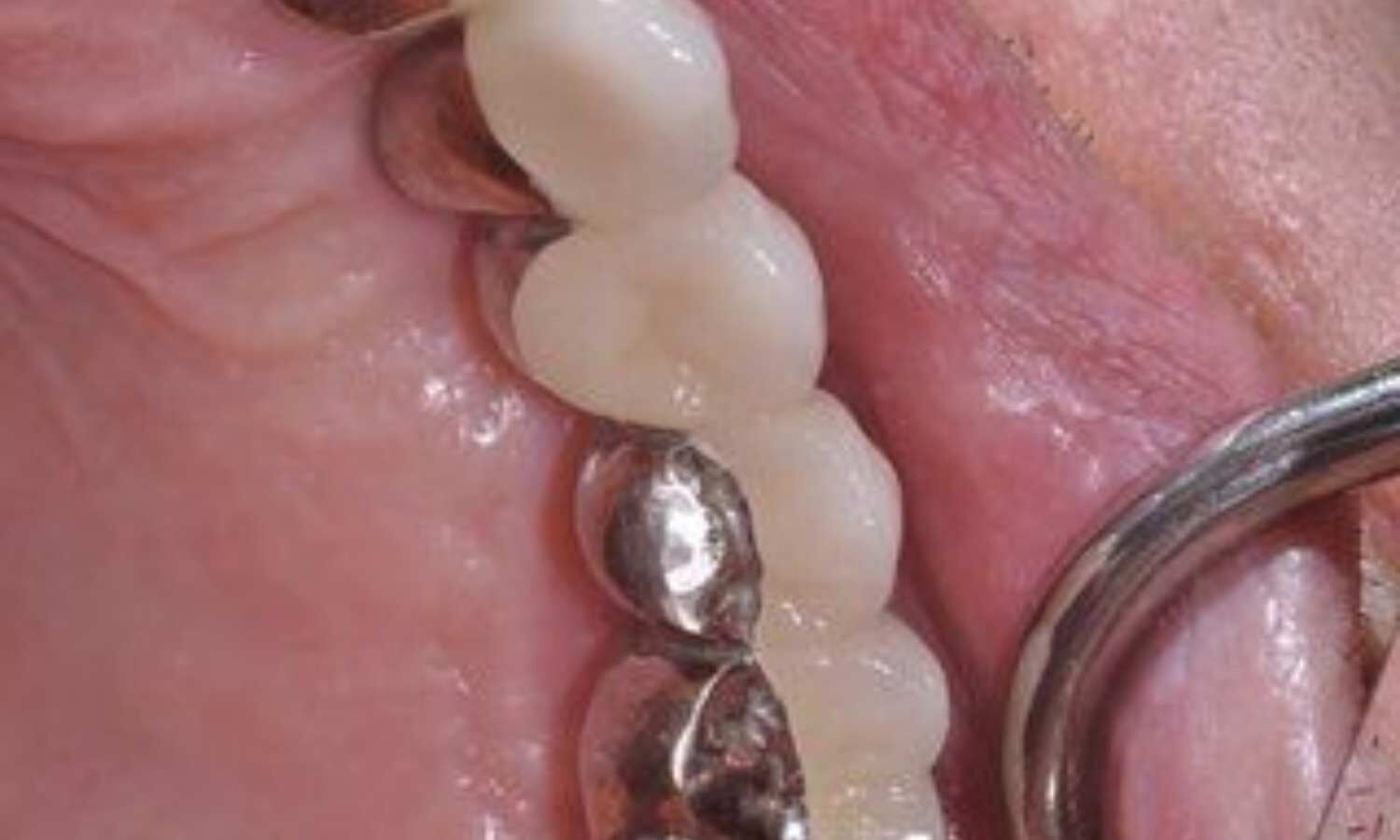 Handgrip force simple and efficient method for predicting Bite Force ...