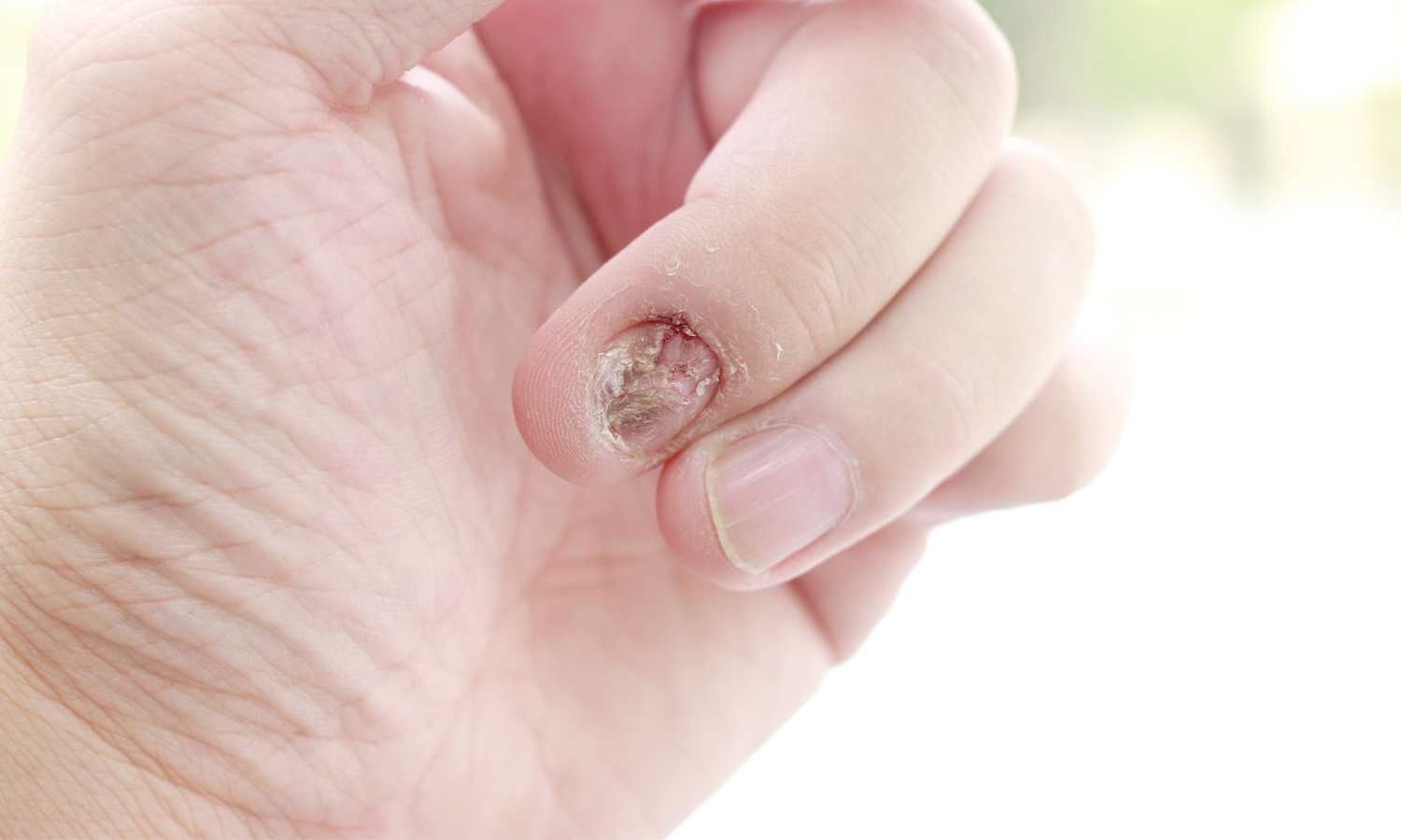 Fungal Infections Unintended Consequence of Advanced Immunotherapy ...