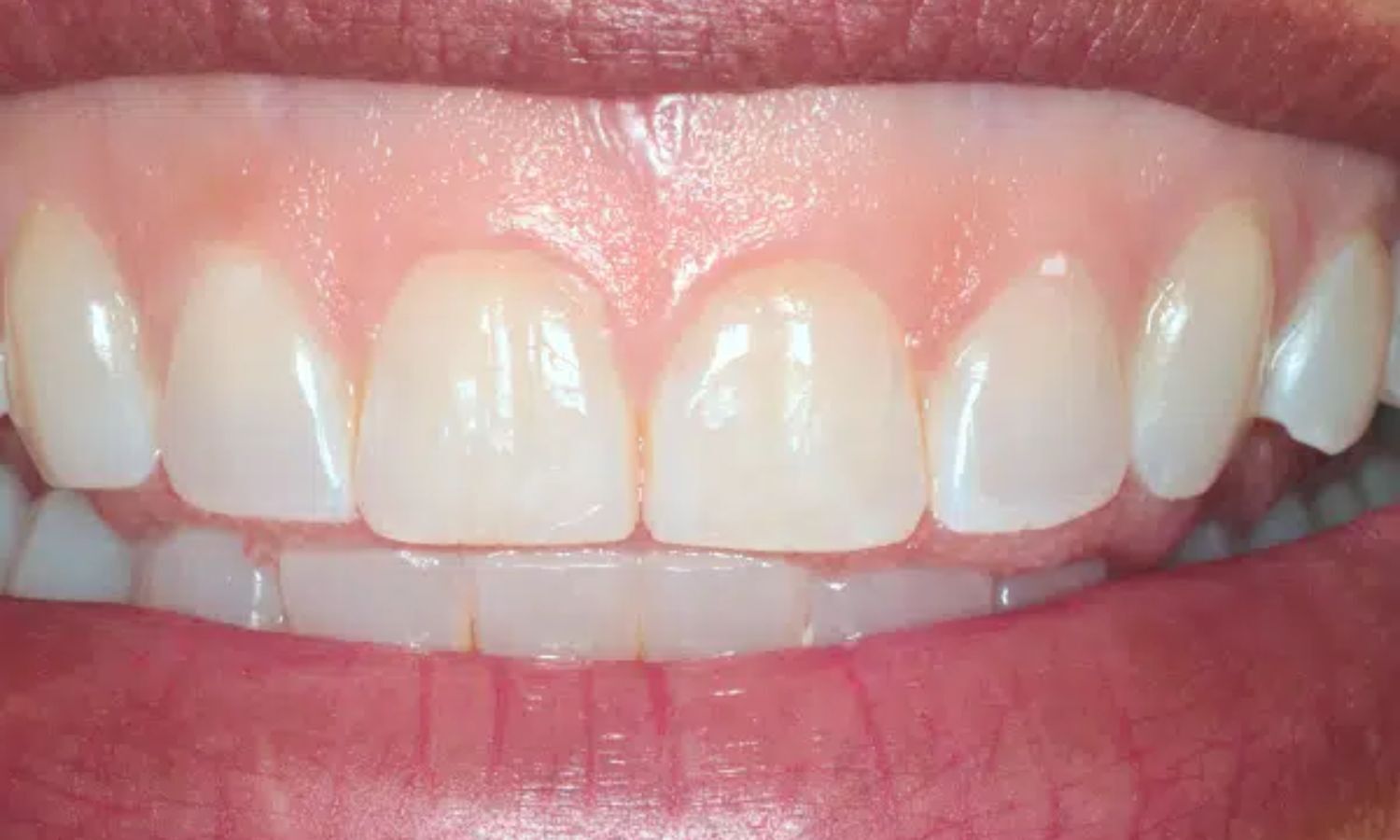 Botulinum toxin type A injections helpful for long-term resolution of ...