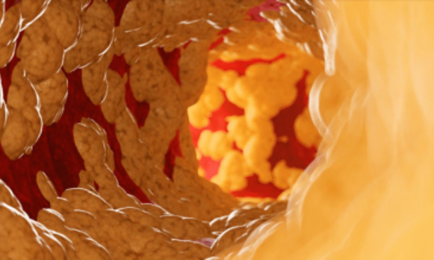 Researchers successfully perform ostial right coronary artery CTO ...