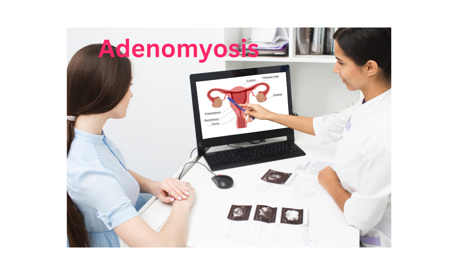 Mifepristone an effective and safe drug for adenomyosis: JAMA