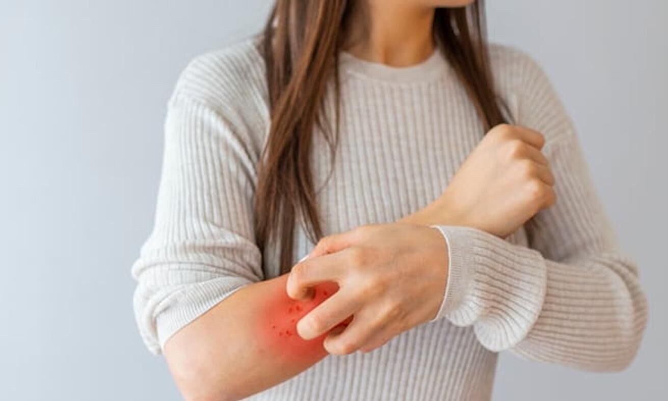 Halometasone cream and fractional CO2 combo effective against eczema