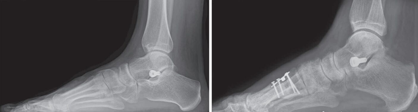 Subtalar arthroereisis with HyProCure-I implant yields good results in ...