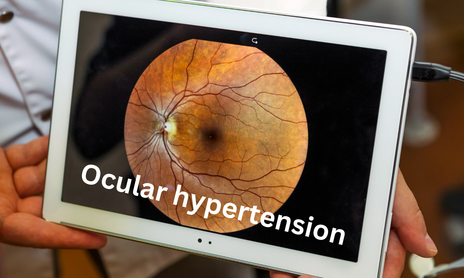 Topical prednisolone acetate usage risk for developing steroid-induced ...