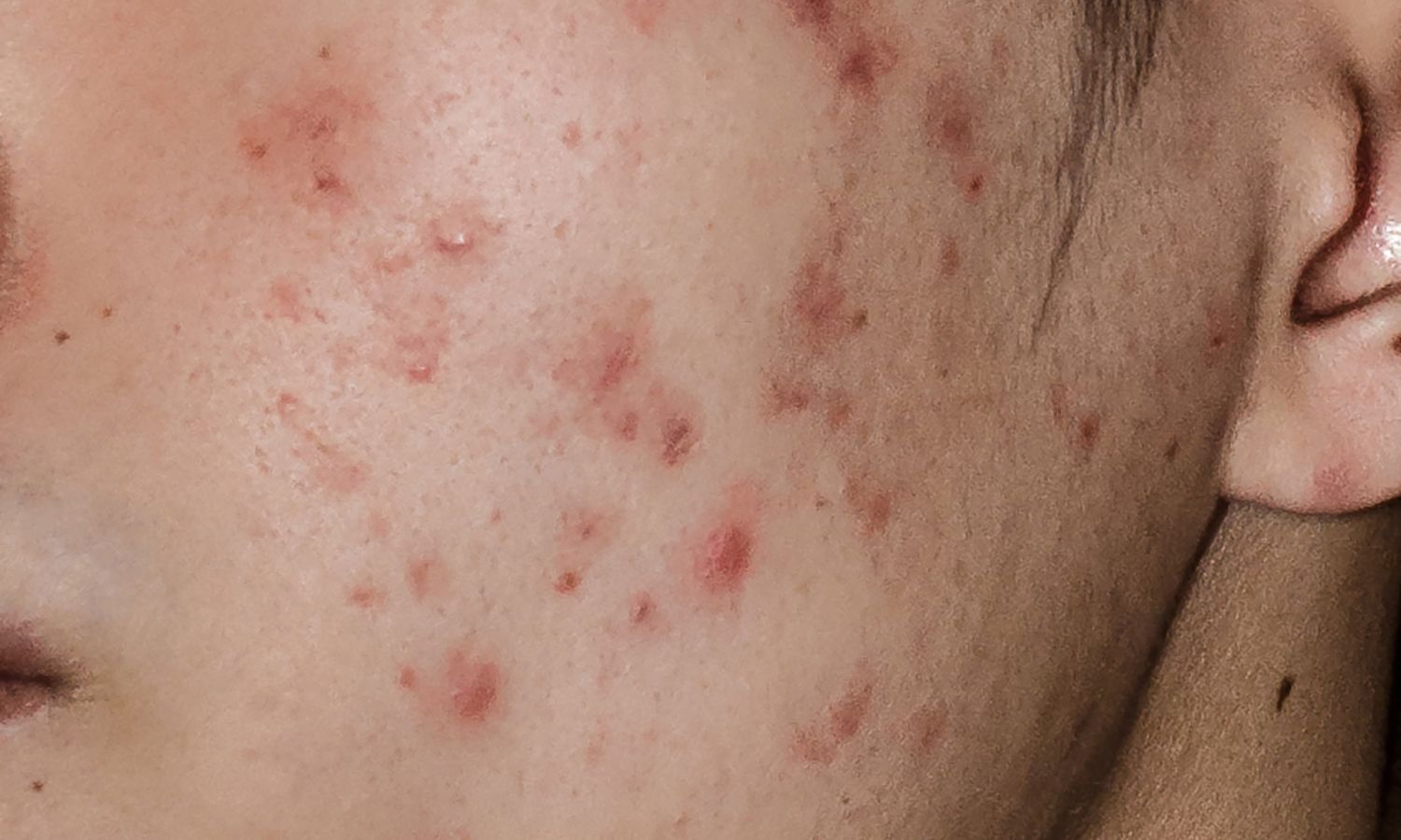 acne scars tied with three risk factors: male gender, positive family ...