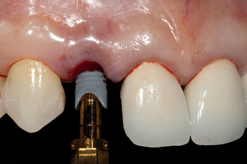 Immediate Implant Placement With Loading more beneficial in midfacial ...