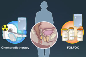 Preoperative FOLFOX as good as chemoradiotherapy for increasing ...