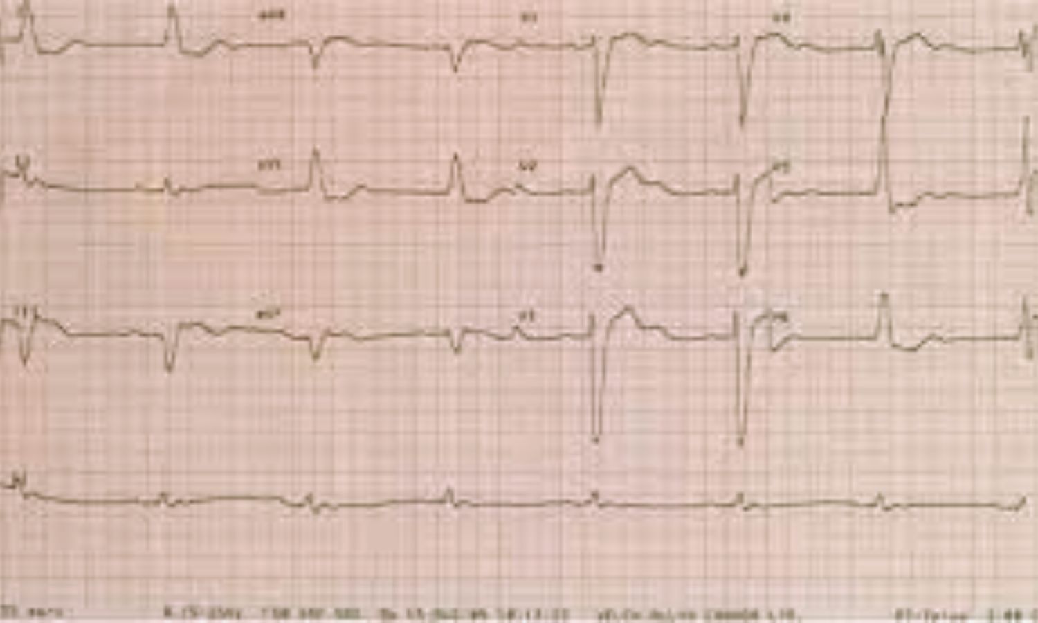 ECG images with AI useful for screening of LV systolic dysfunction