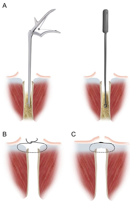 Scooping Technique for iliac crest may harvest substantial amount of ...