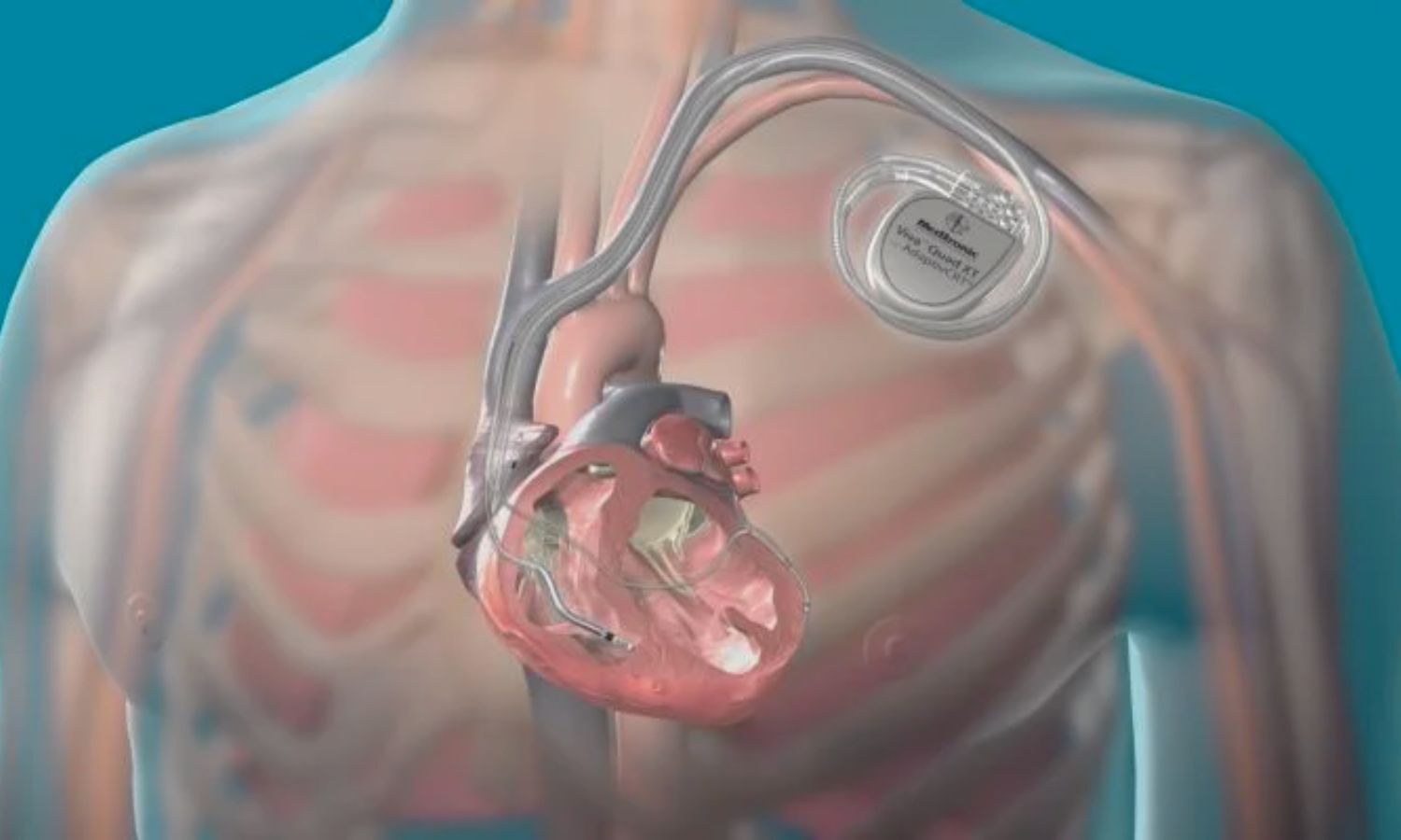 Nonindicated dual-chamber ICDs implantation for prevention of tied to ...